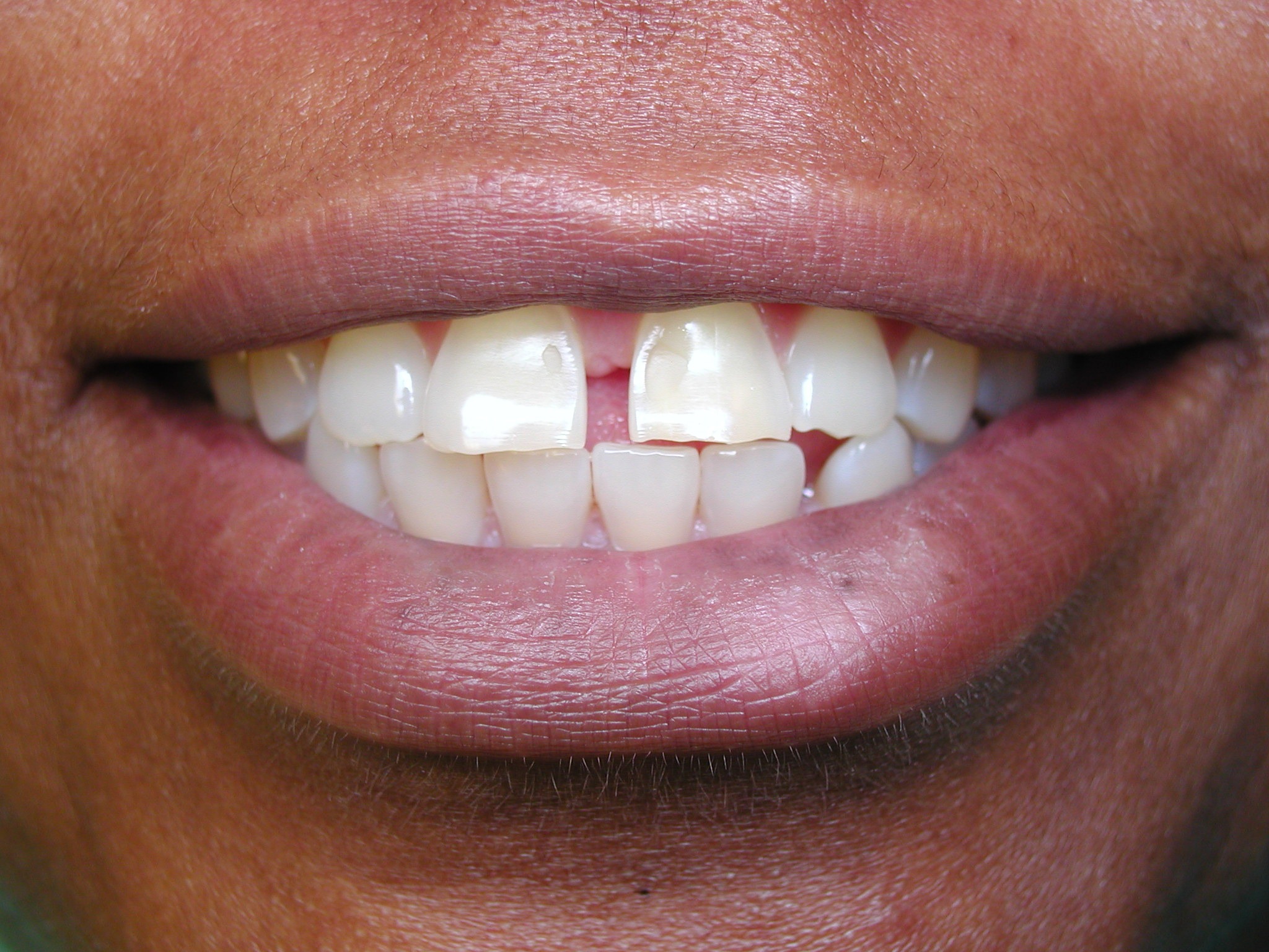 Closing A Mid line Gap Between Upper Teeth